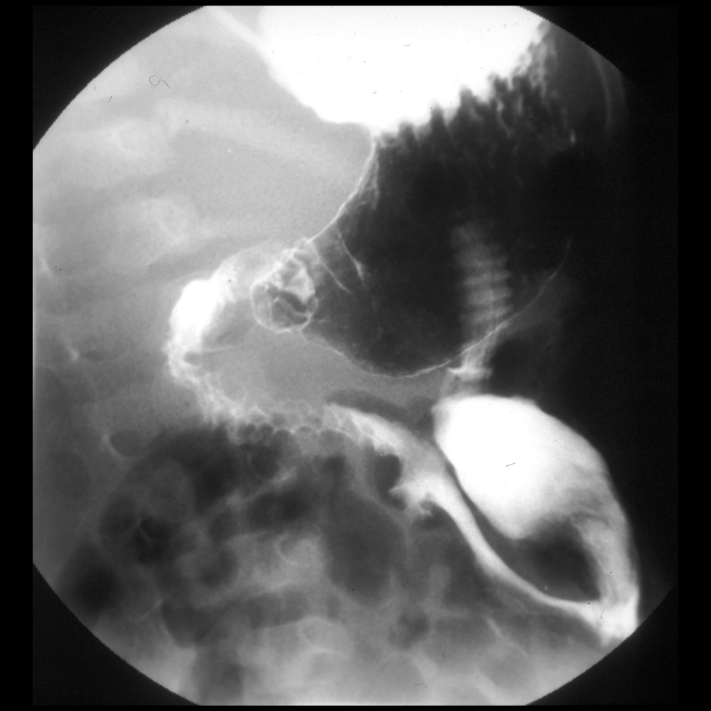 Child Abuse Visceral Injury | Pediatric Radiology Reference Article ...