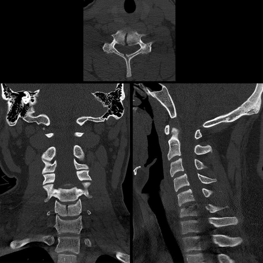 Pediatric Cervical Spine Fracture | Pediatric Radiology Reference ...