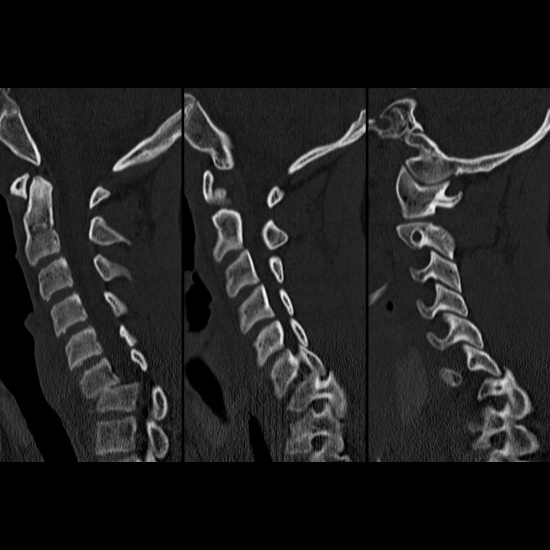 Pediatric Cervical Spine Fracture | Pediatric Radiology Reference ...
