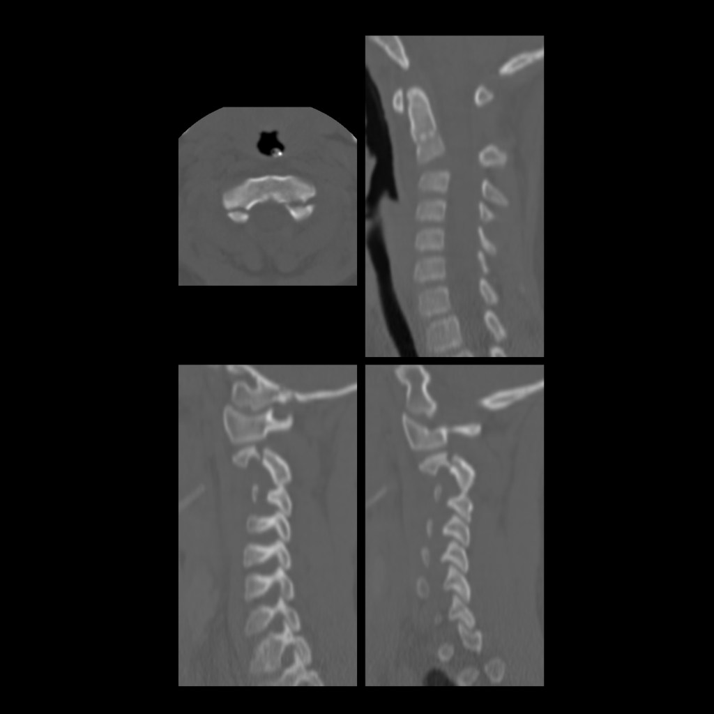 Pediatric Hangman Cervical Spine Fracture | Pediatric Radiology ...