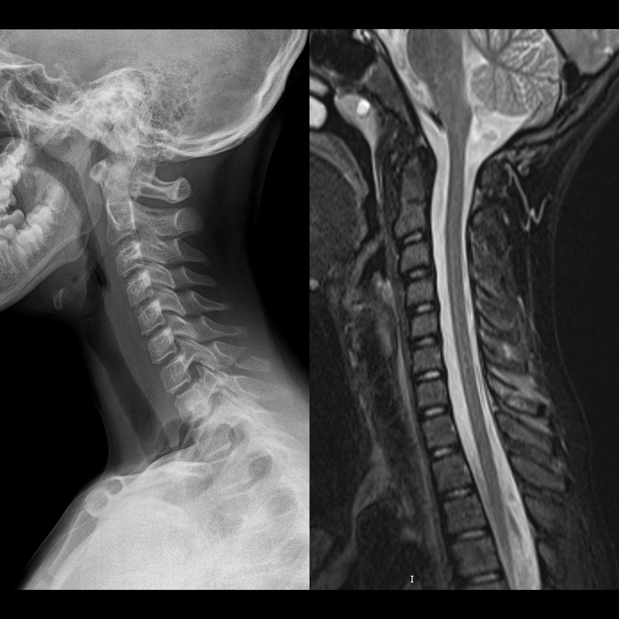 Pediatric Clay Shoveler Cervical Spine Fracture | Pediatric Radiology ...
