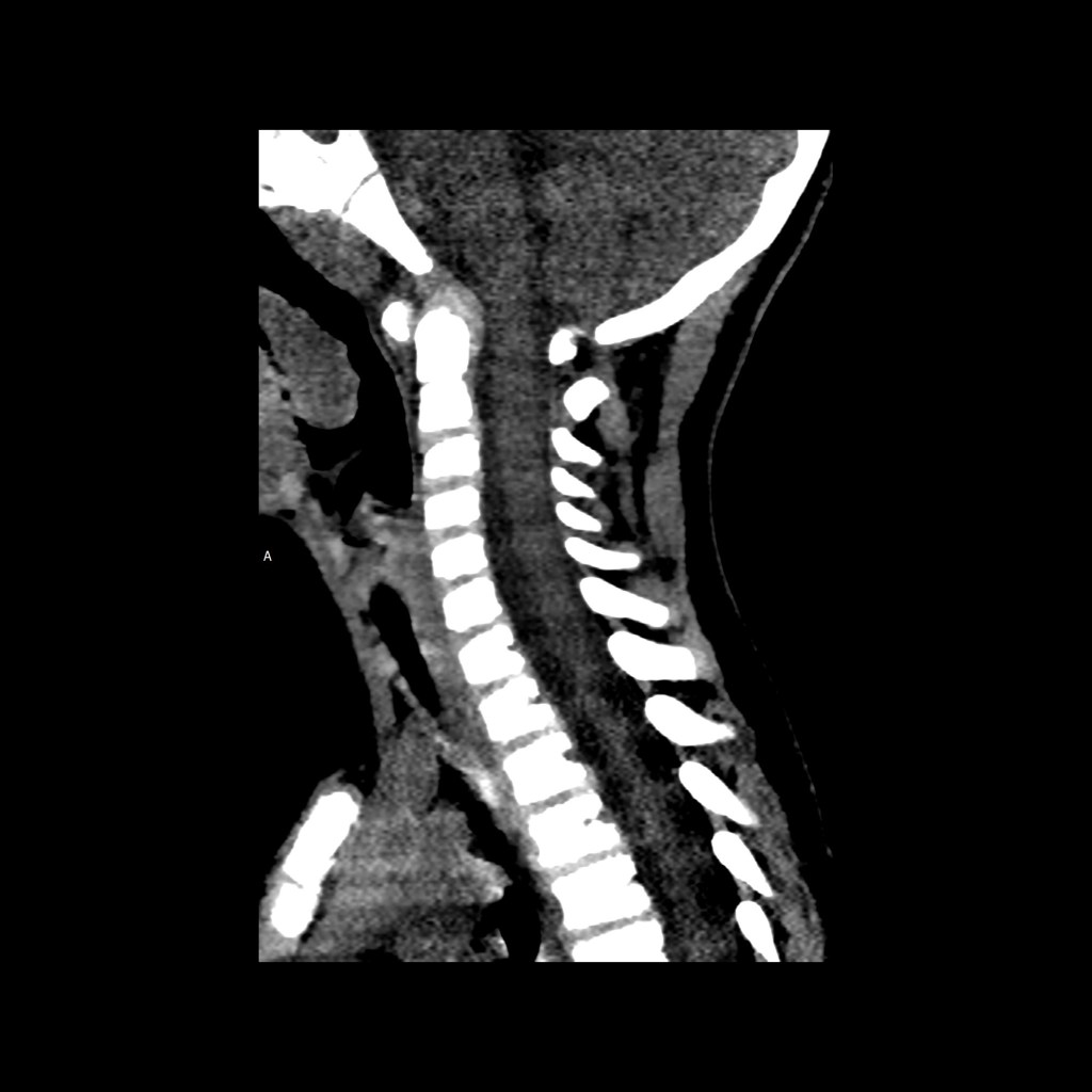 Normal Cervical Spine Radiographs Image Radiopaediaorg Cervical Spine