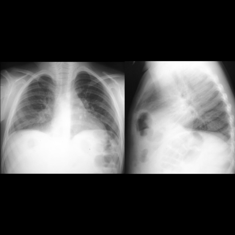 Morgagni Hernia | Pediatric Radiology Reference Article | Pediatric ...