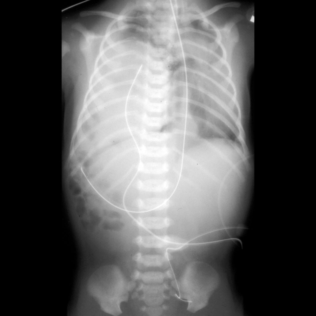 Congenital Diaphragmatic Hernia | Pediatric Radiology Reference Article ...