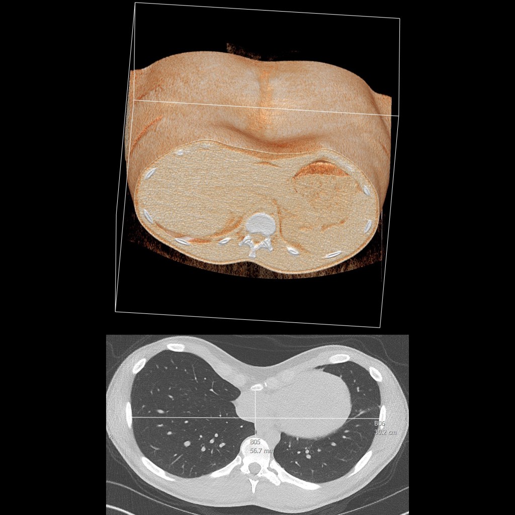 Pectus Excavatum | Pediatric Radiology Reference Article | Pediatric ...