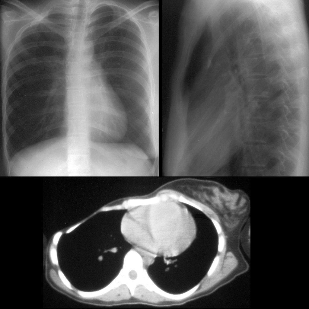 Pediatric Poland Syndrome | Pediatric Radiology Reference Article ...