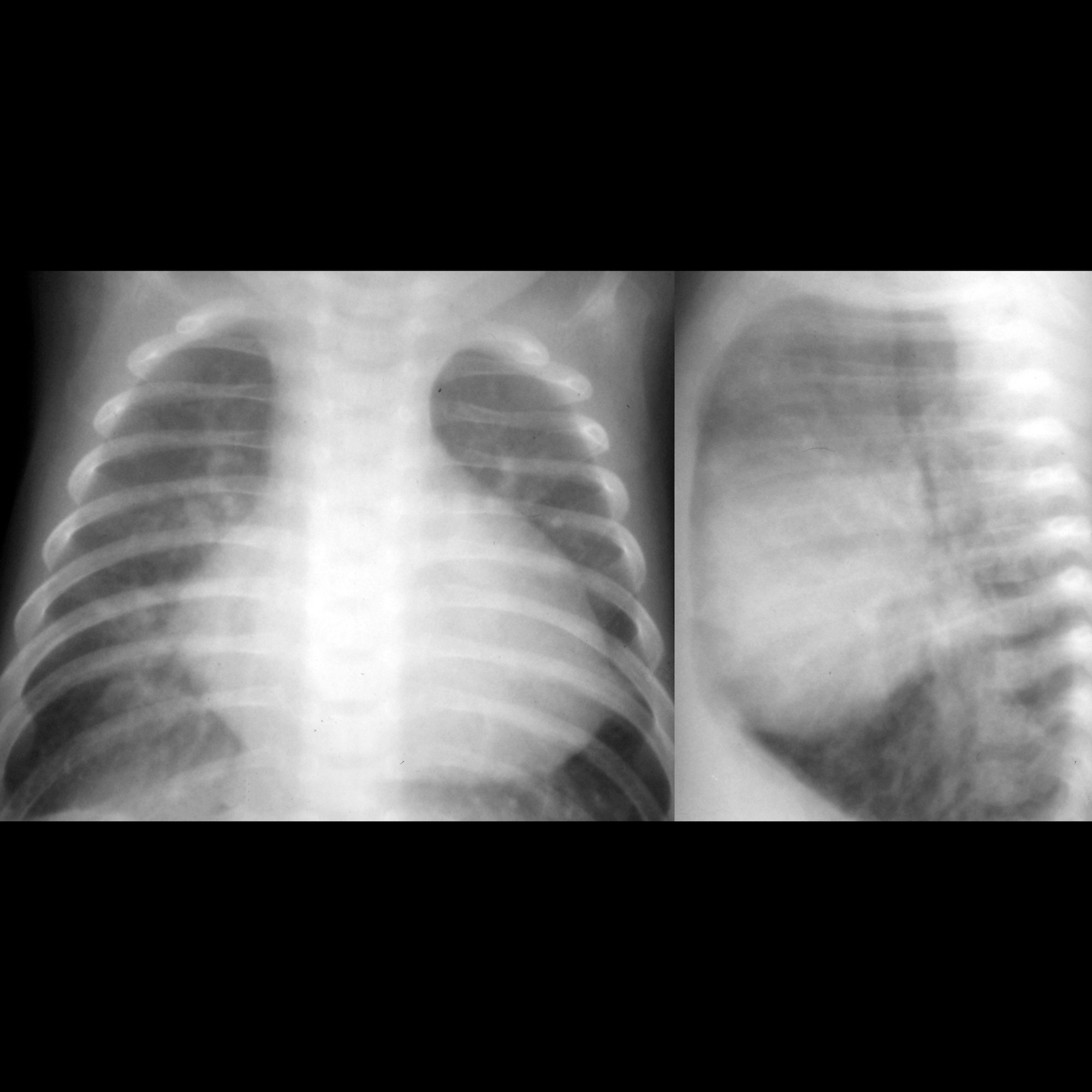 Endocardial Cushion Defect X Ray