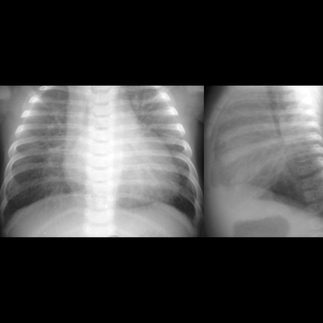 Pediatric Infective Endocarditis | Pediatric Radiology Reference ...