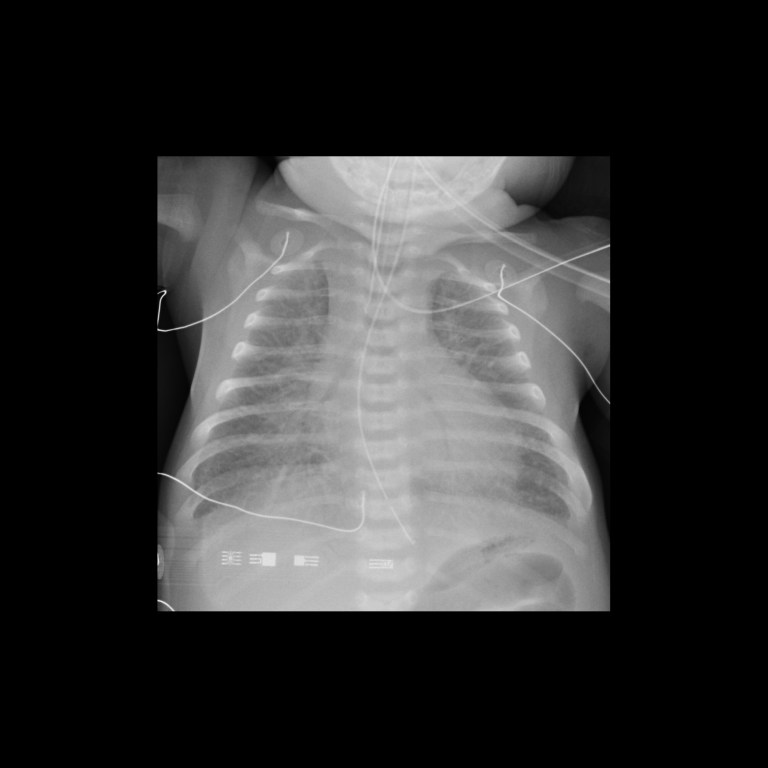 Pediatric Pulmonary Edema | Pediatric Radiology Reference Article ...