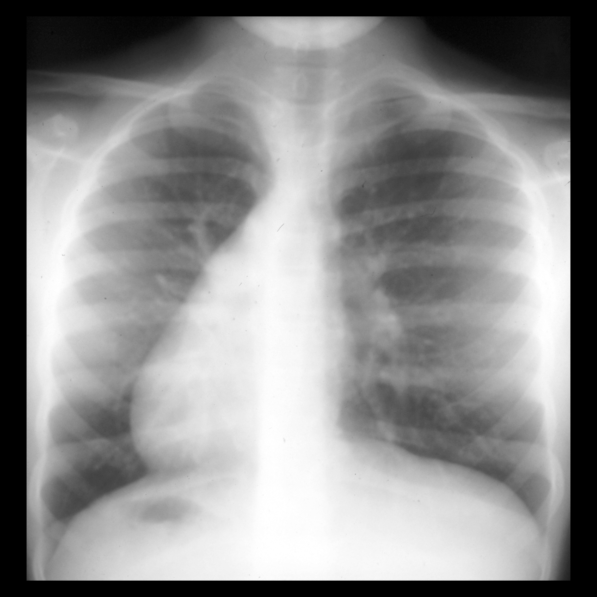 Situs Inversus | Pediatric Radiology Reference Article | Pediatric ...