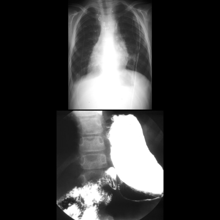 Situs Inversus | Pediatric Radiology Reference Article | Pediatric ...