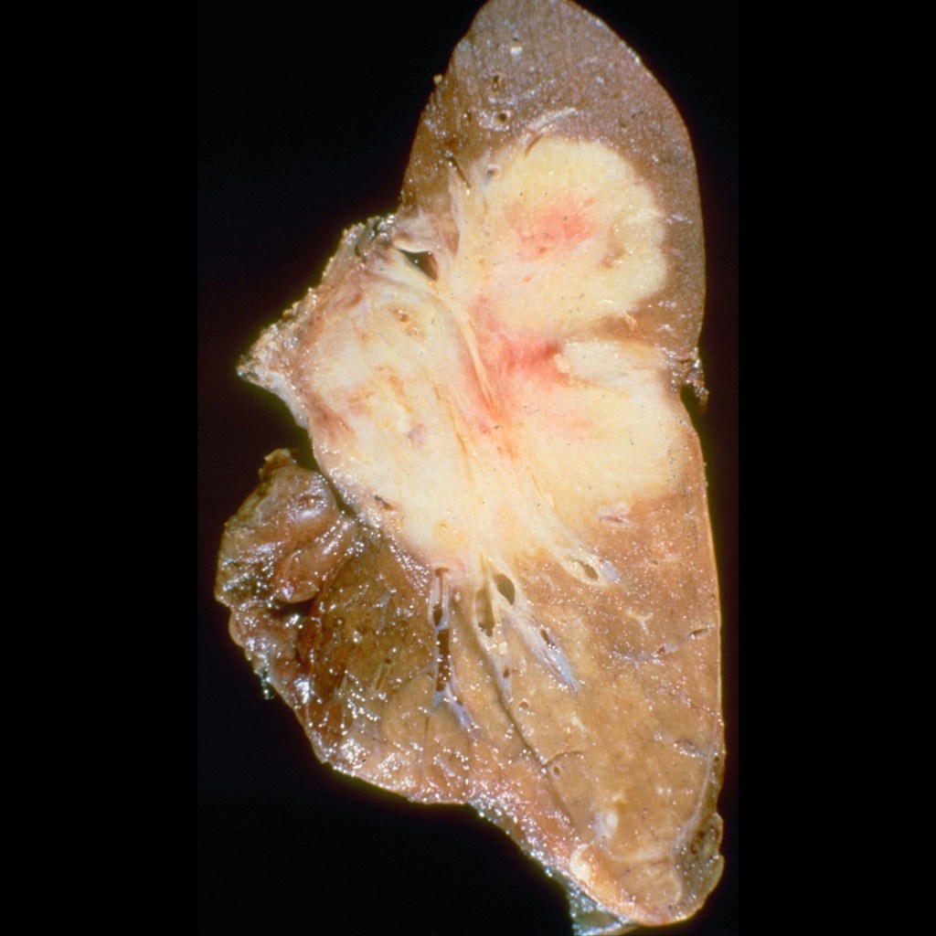 Pediatric Inflammatory Myofibroblastic Tumor | Pediatric Radiology ...