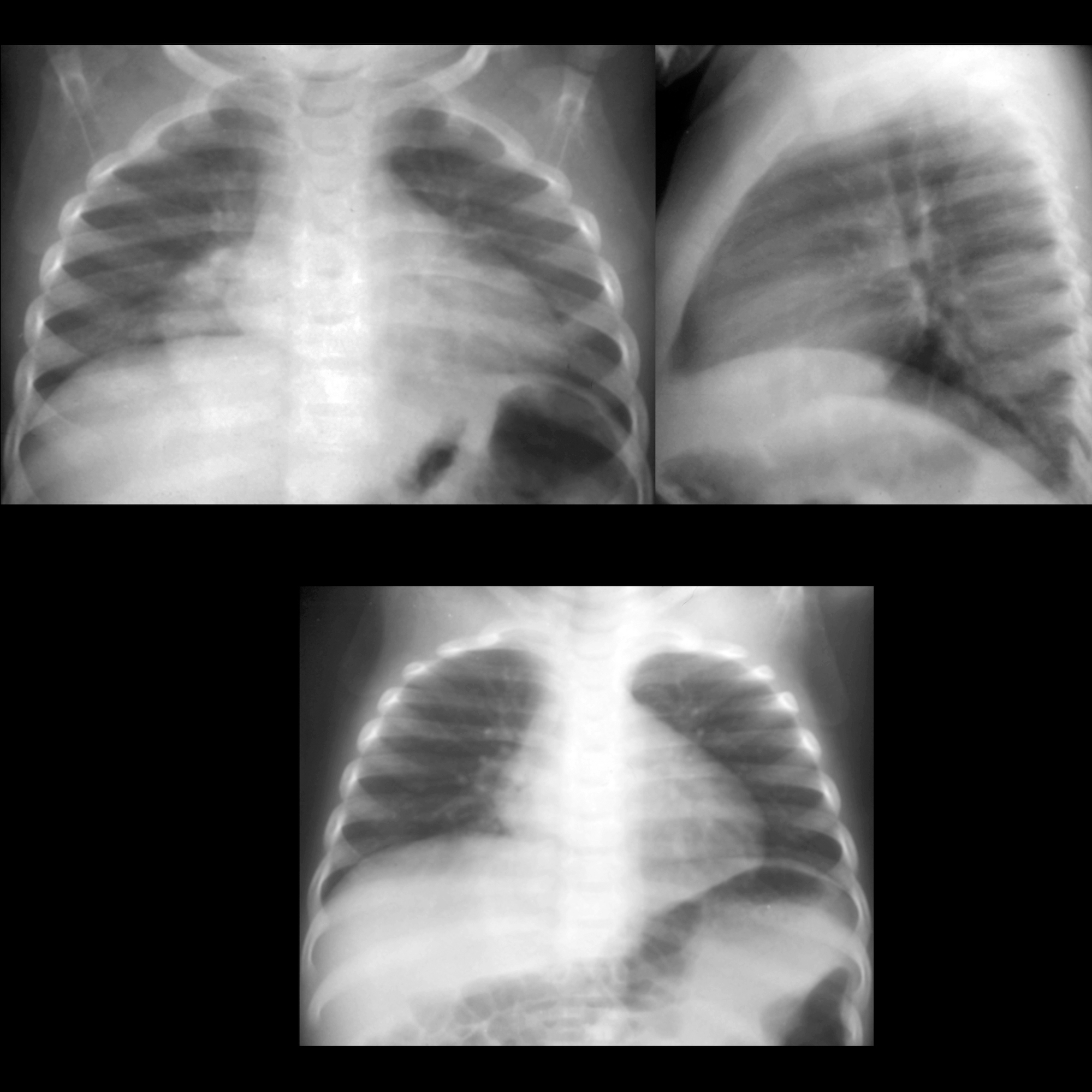 Preschooler with cough and fever | Pediatric Radiology Case | Pediatric ...
