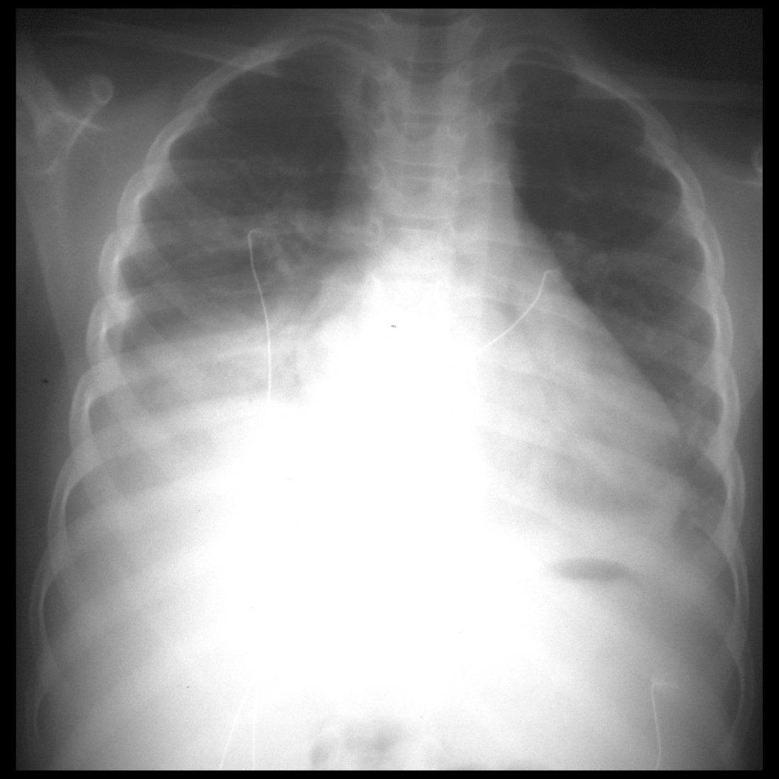 Pediatric Acute Chest Syndrome | Pediatric Radiology Reference Article ...