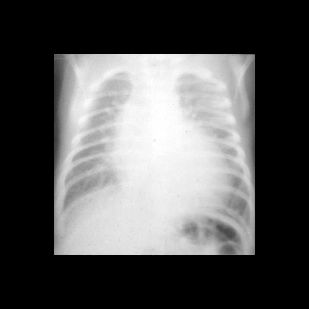 Transposition of the Great Arteries | Pediatric Radiology Reference ...