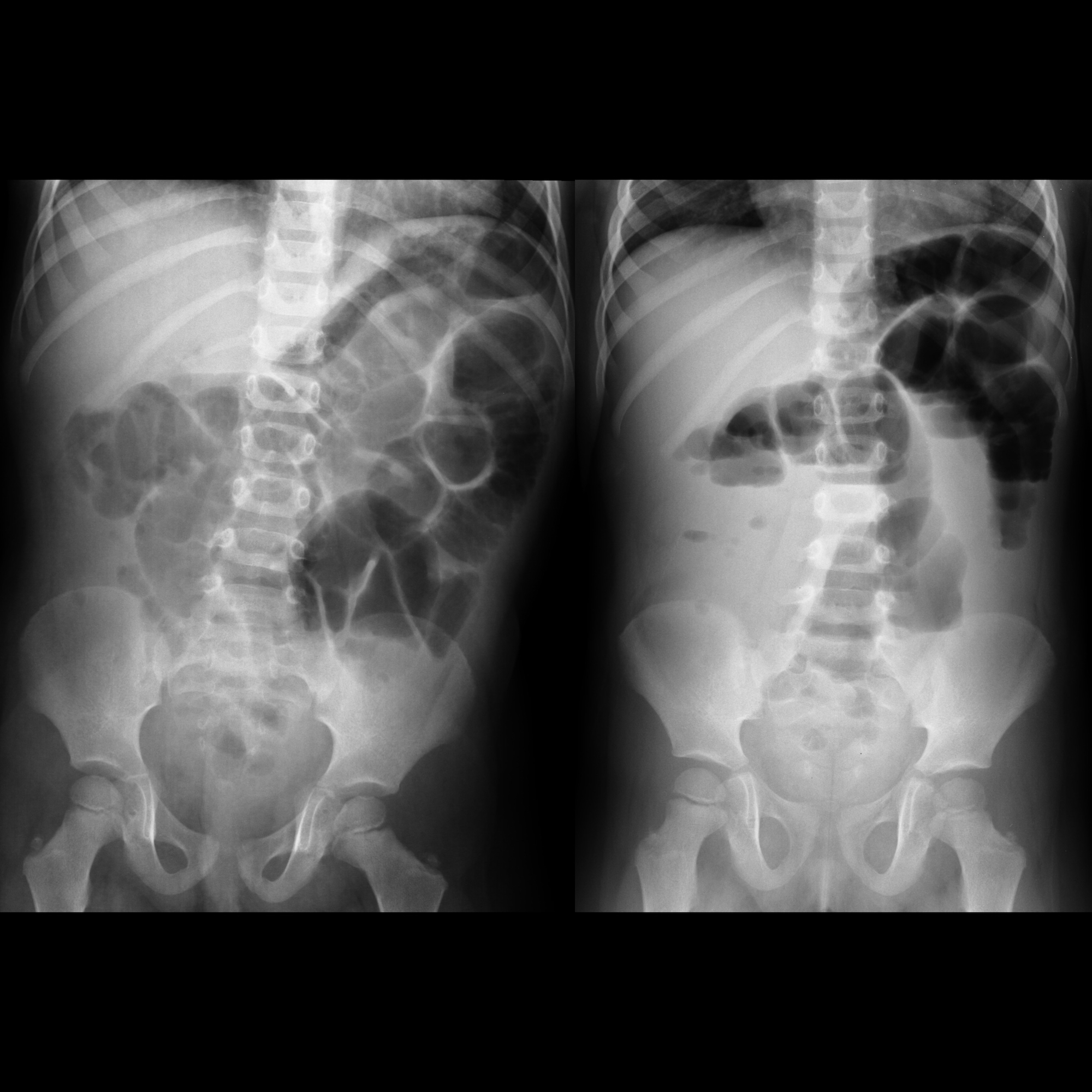 Pediatric Appendicitis | Pediatric Radiology Reference Article ...