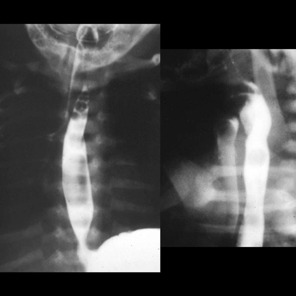 Toddler with long-standing vomiting after eating | Pediatric Radiology ...