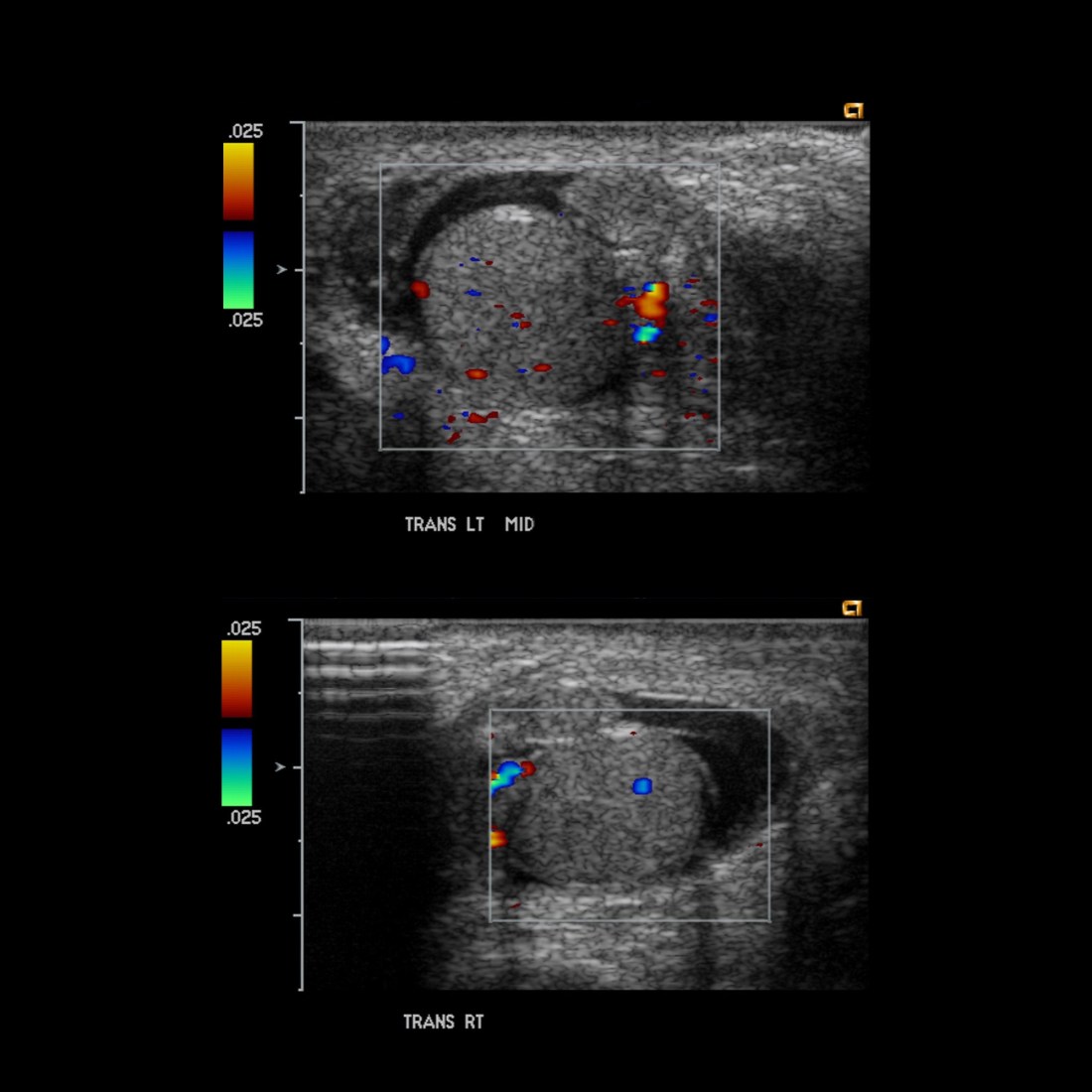 Pediatric Henoch-Schonlein Purpura | Pediatric Radiology Reference ...