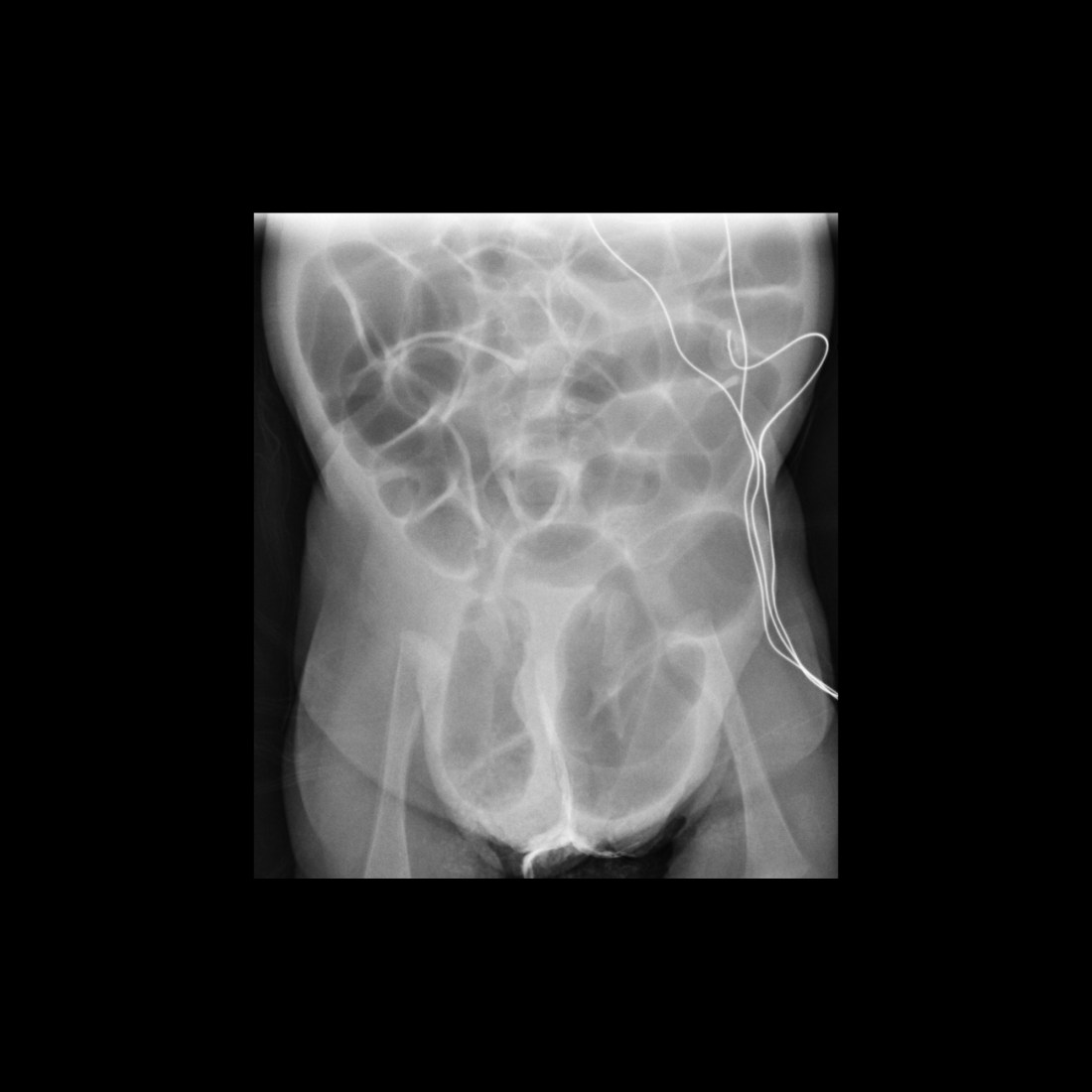 Pediatric Small Bowel Obstruction | Pediatric Radiology Reference ...