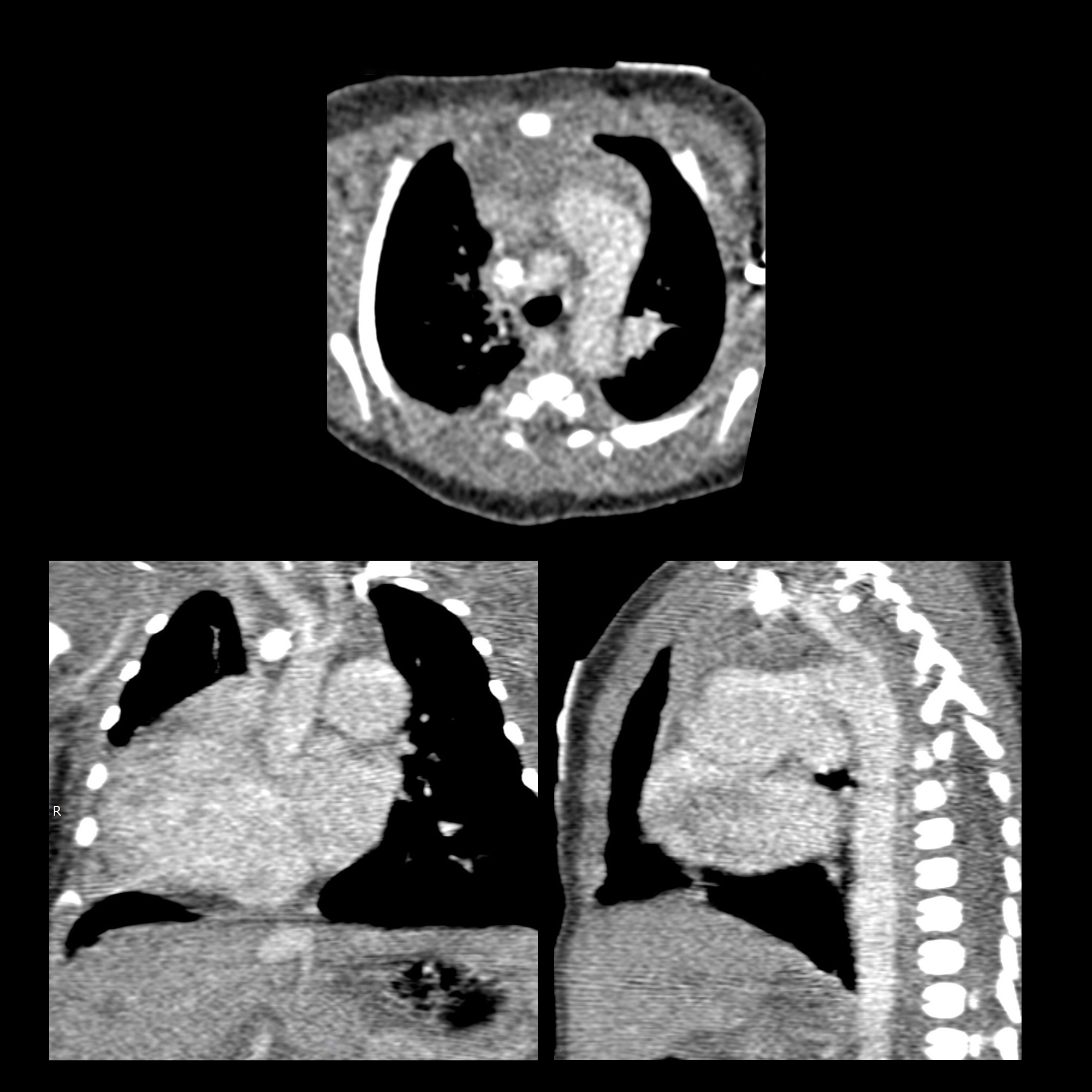 Situs Inversus | Pediatric Radiology Reference Article | Pediatric ...