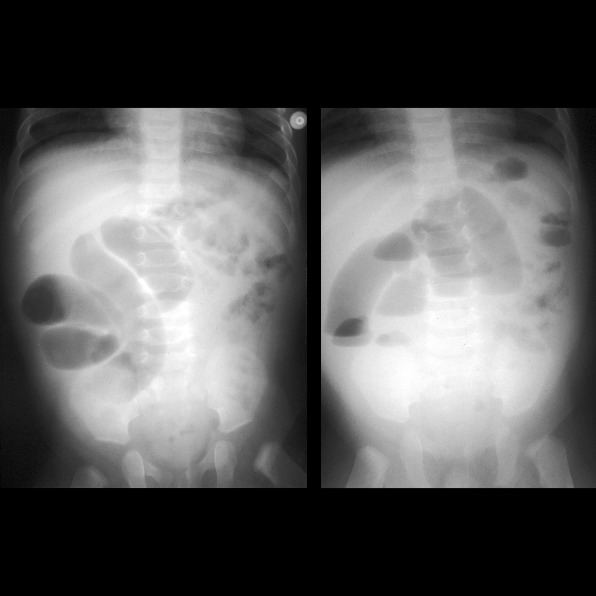 Intussusception07TCHPeritonitisNoEnemaAXRSupineUpright5mo | Pediatric ...