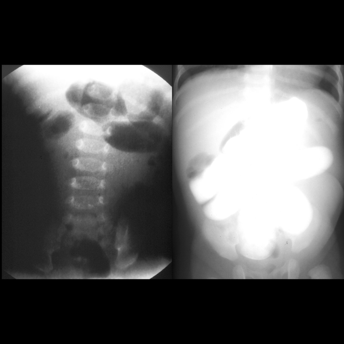 Pediatric Abdominal Adhesions | Pediatric Radiology Reference Article ...