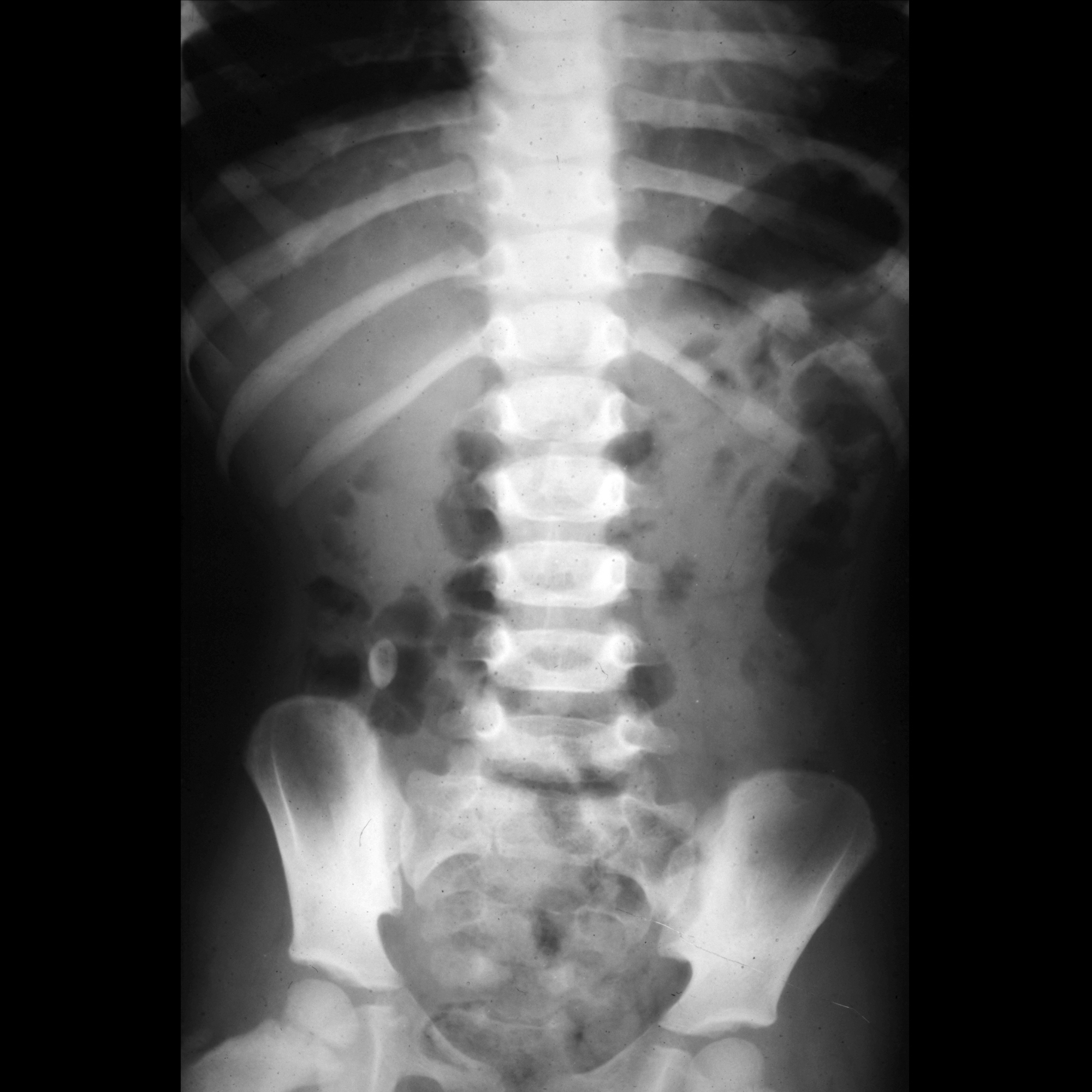 Pediatric Appendicitis | Pediatric Radiology Reference Article ...