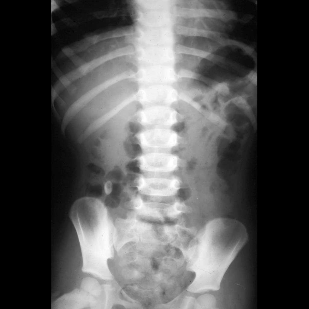 Pediatric Appendicitis | Pediatric Radiology Reference Article ...