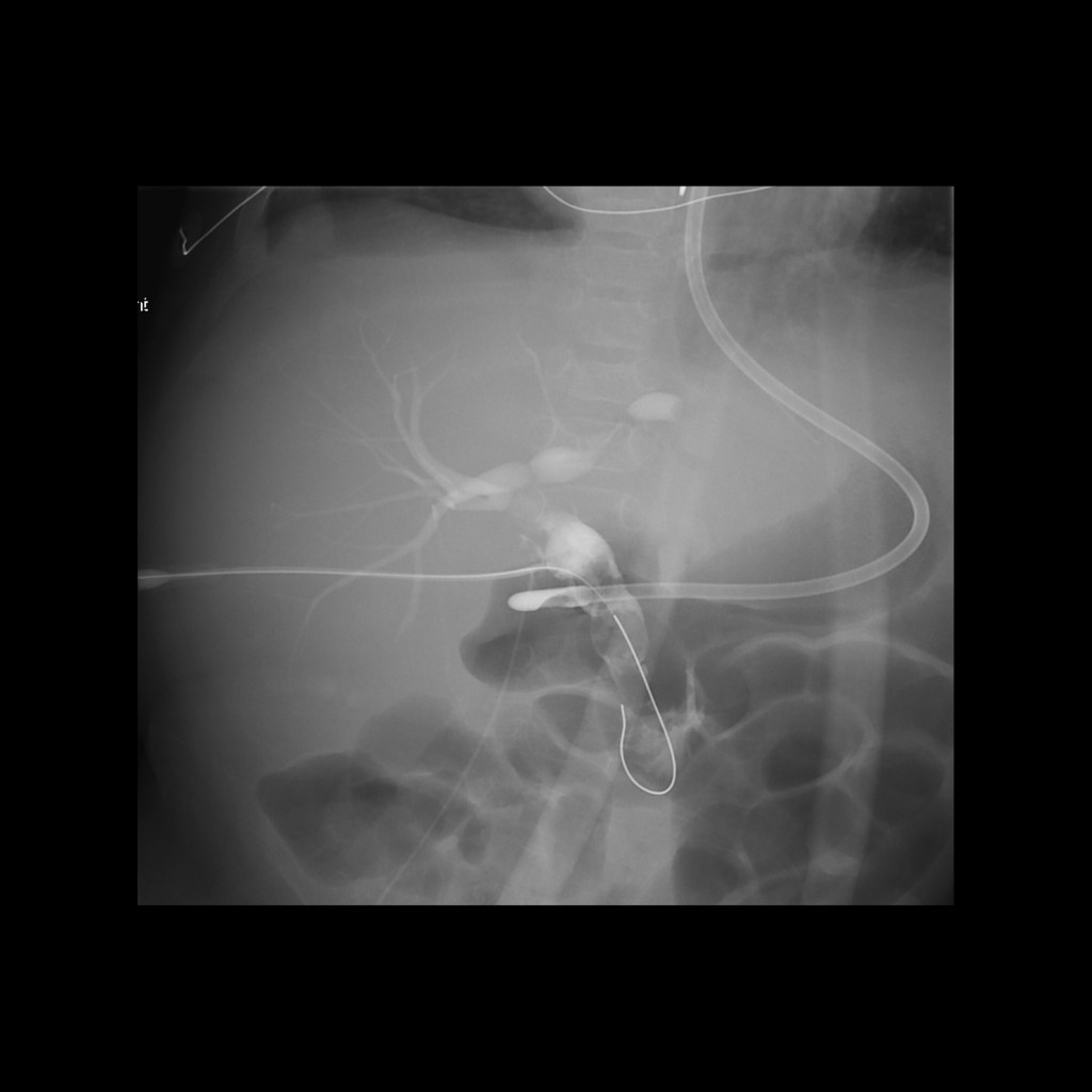 Bile Plug Syndrome | Pediatric Radiology Reference Article | Pediatric ...