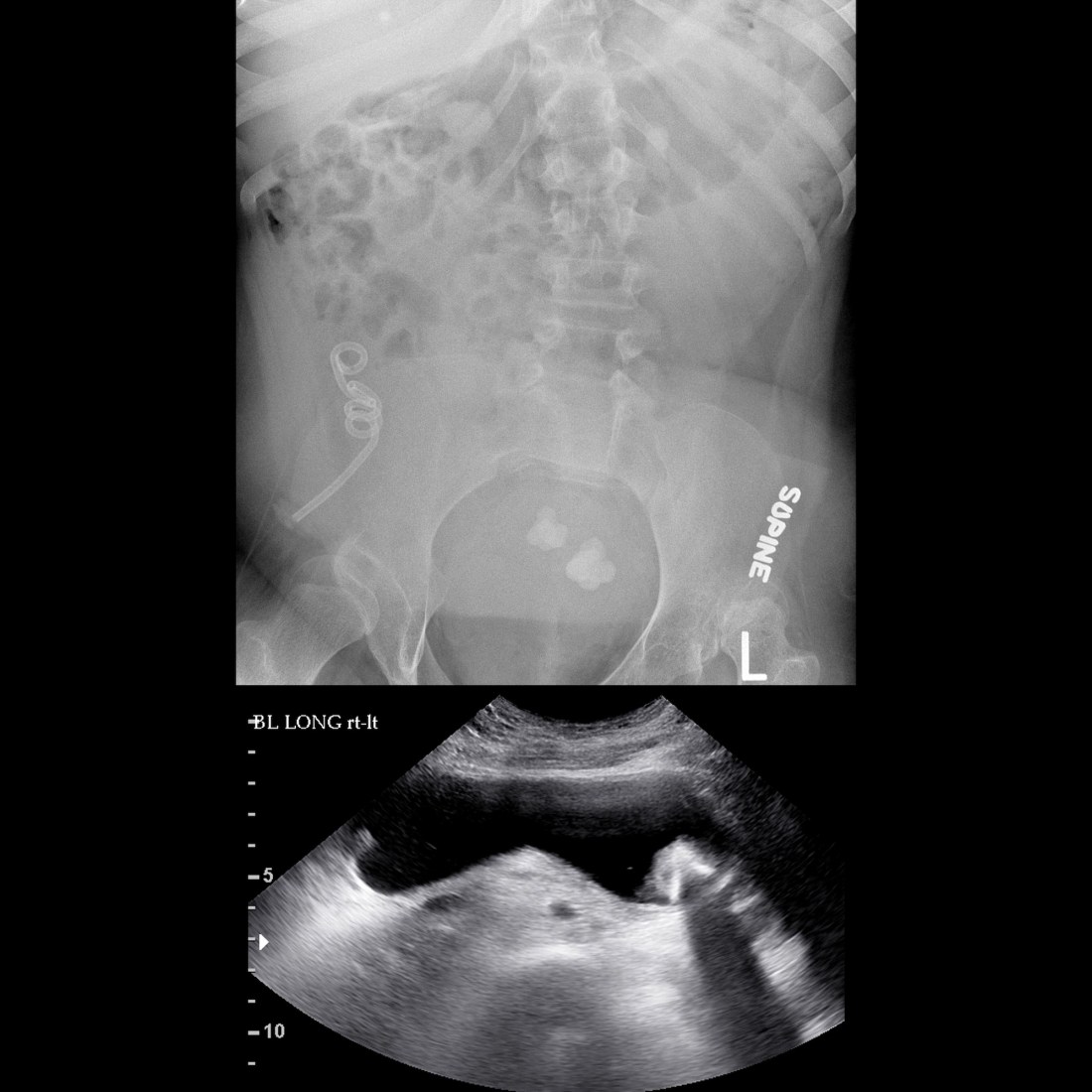 Pediatric Neurogenic Bladder | Pediatric Radiology Reference Article ...