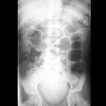 Pediatric Constipation | Pediatric Radiology Reference Article ...