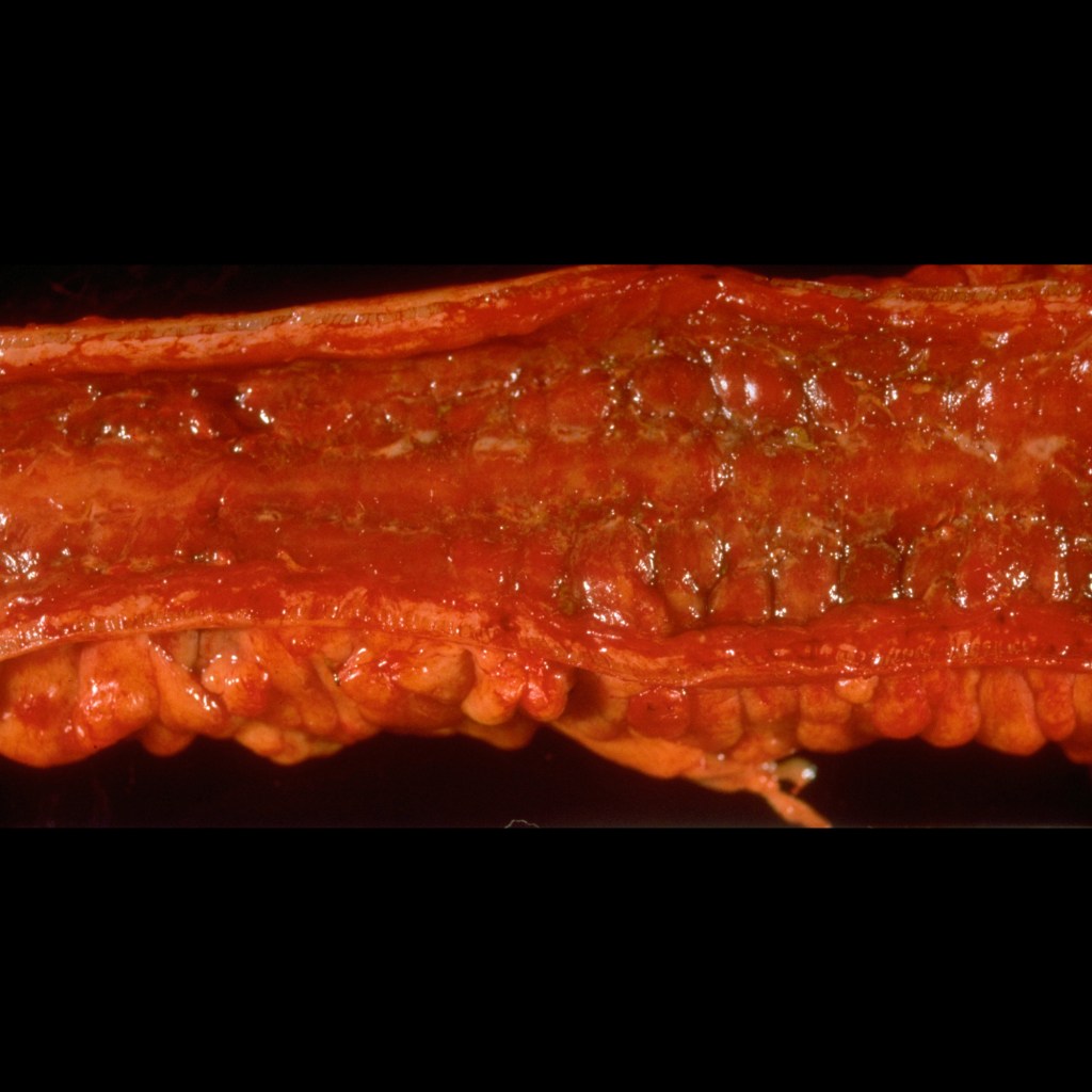 Teenager with abdominal pain and vomiting with a narrowed terminal ...