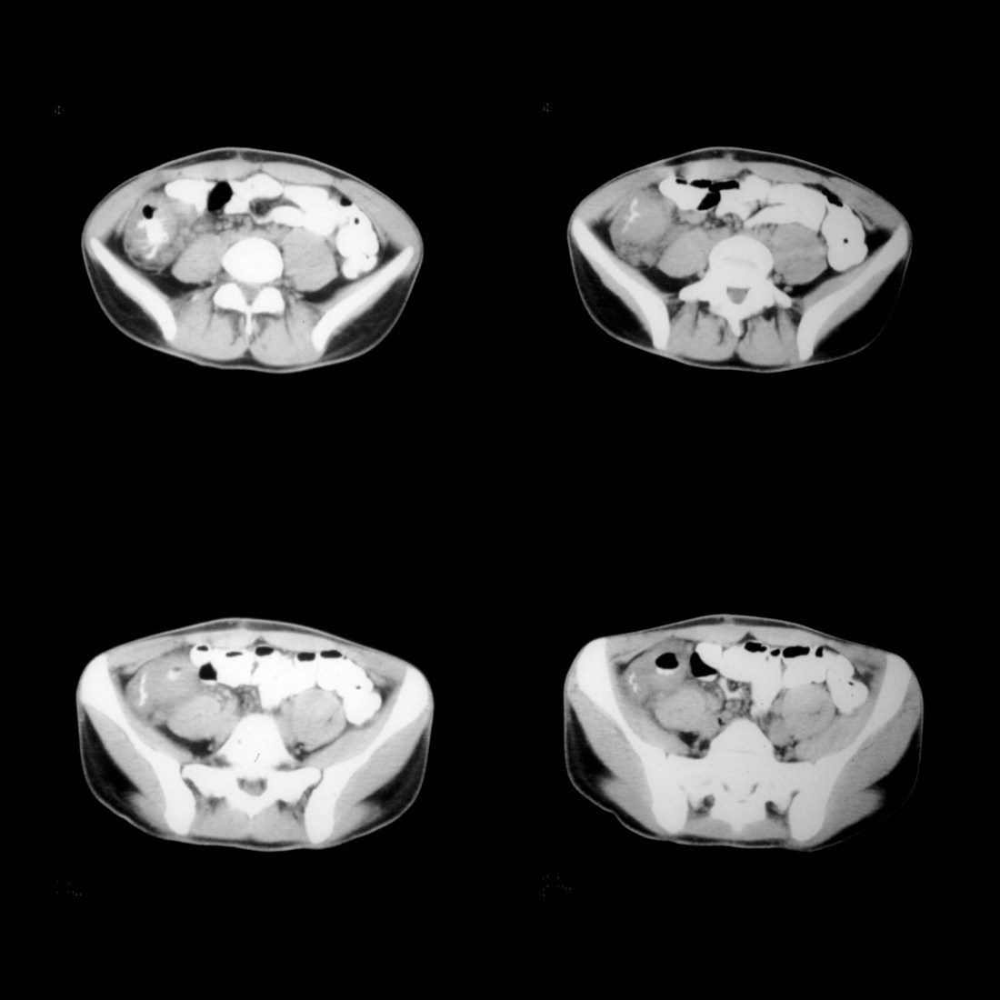 Pediatric Crohn Disease | Pediatric Radiology Reference Article ...