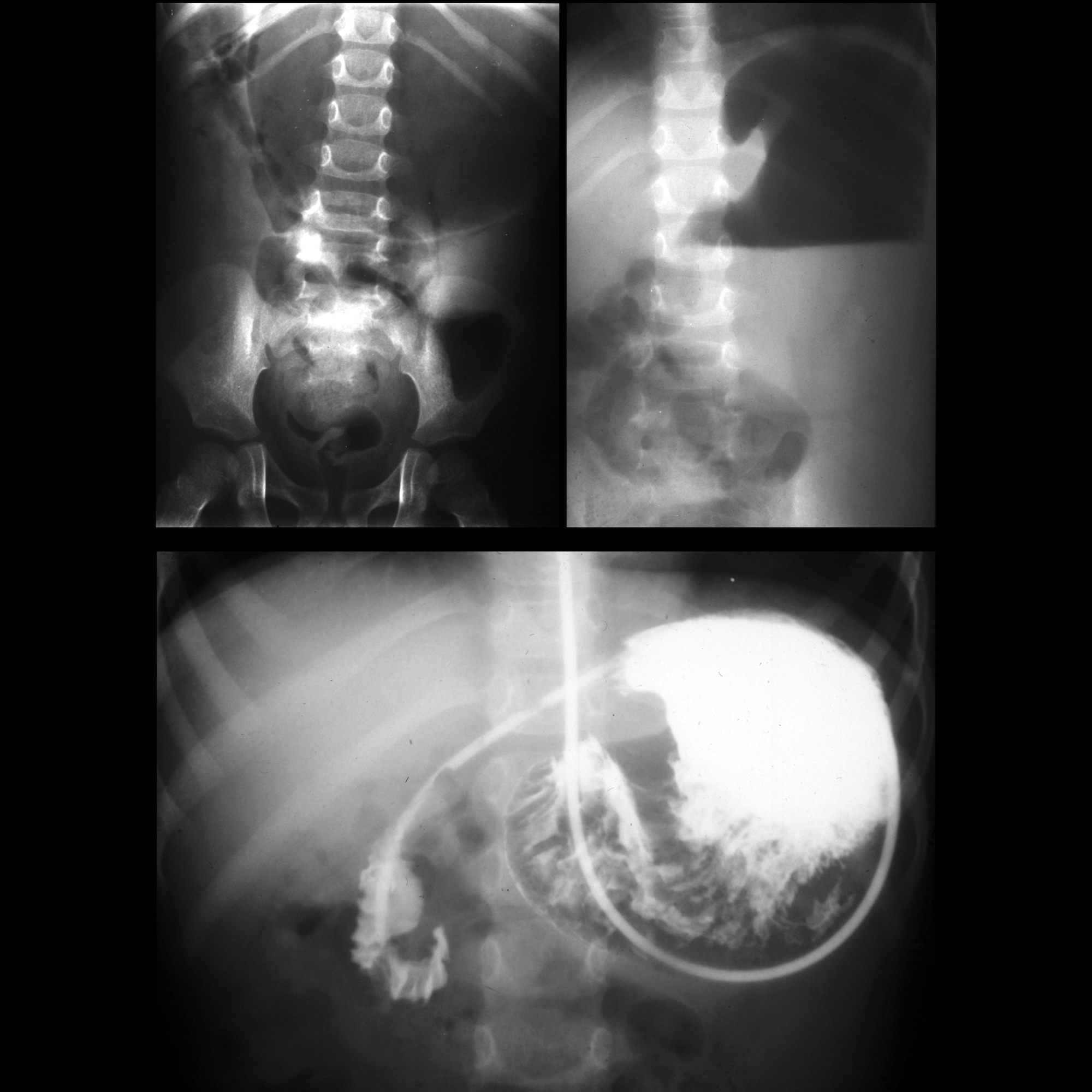 Pediatric Mesenteroaxial Gastric Volvulus | Pediatric Radiology ...