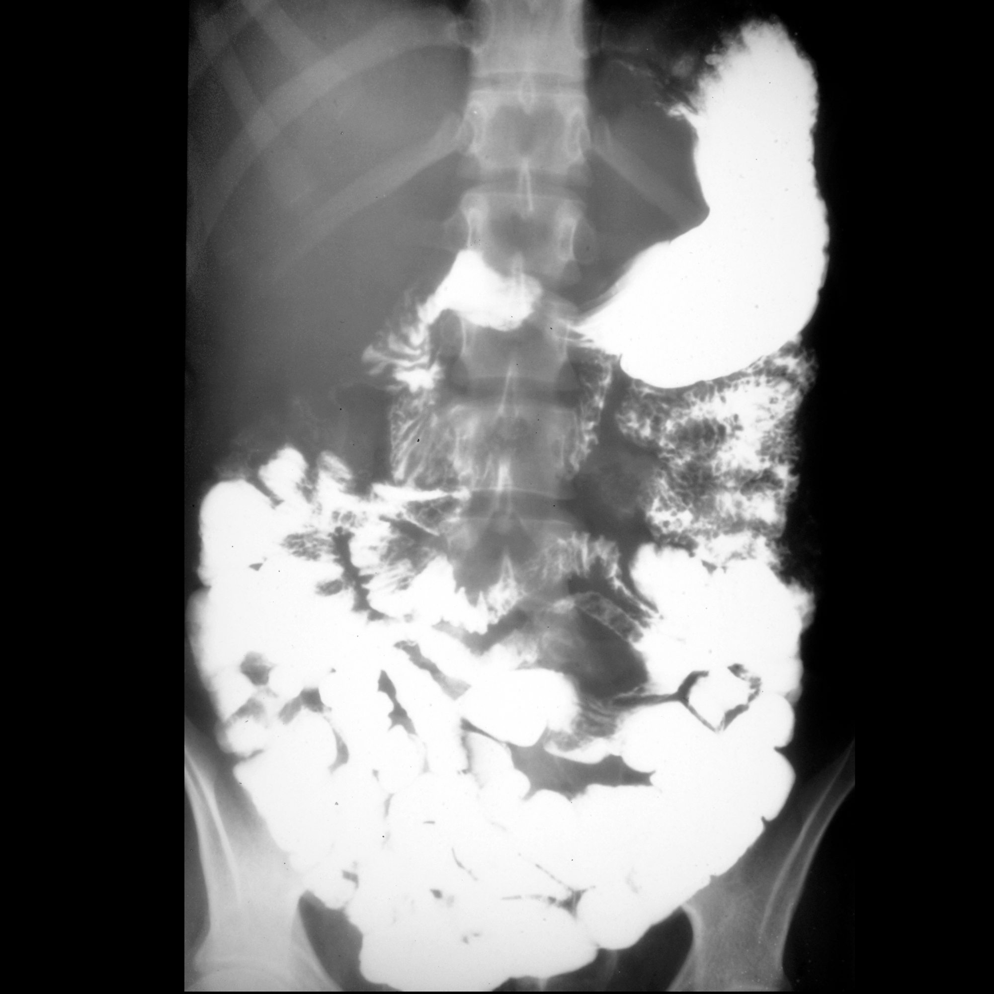 Pediatric Graft Versus Host Disease | Pediatric Radiology Reference ...