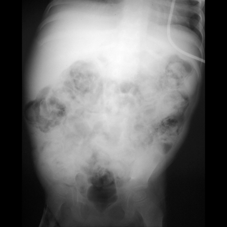 Pediatric Pneumatosis Intestinalis | Pediatric Radiology Reference ...