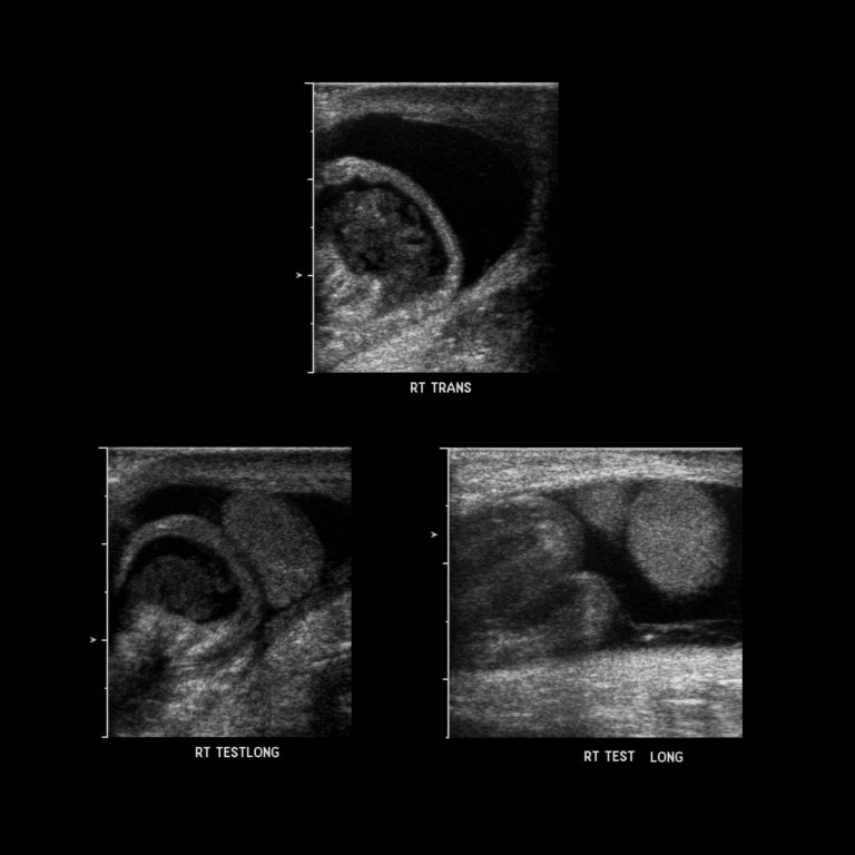 Pediatric Inguinal Hernia | Pediatric Radiology Reference Article ...