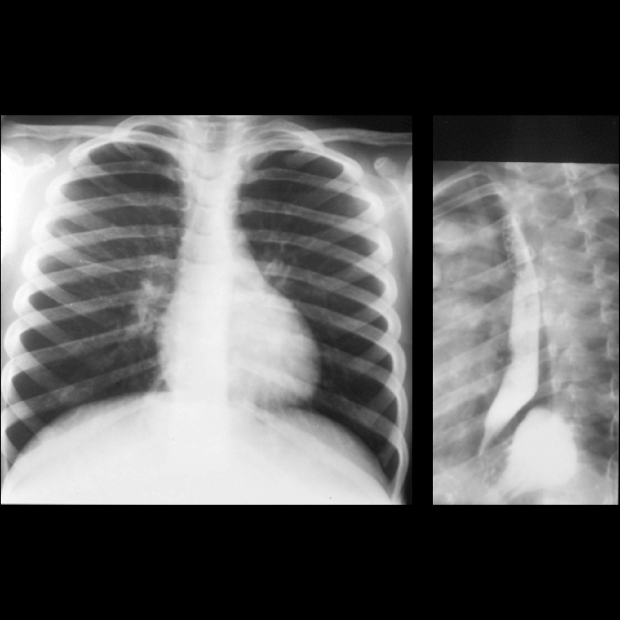 Pediatric Hiatal Hernia | Pediatric Radiology Reference Article ...