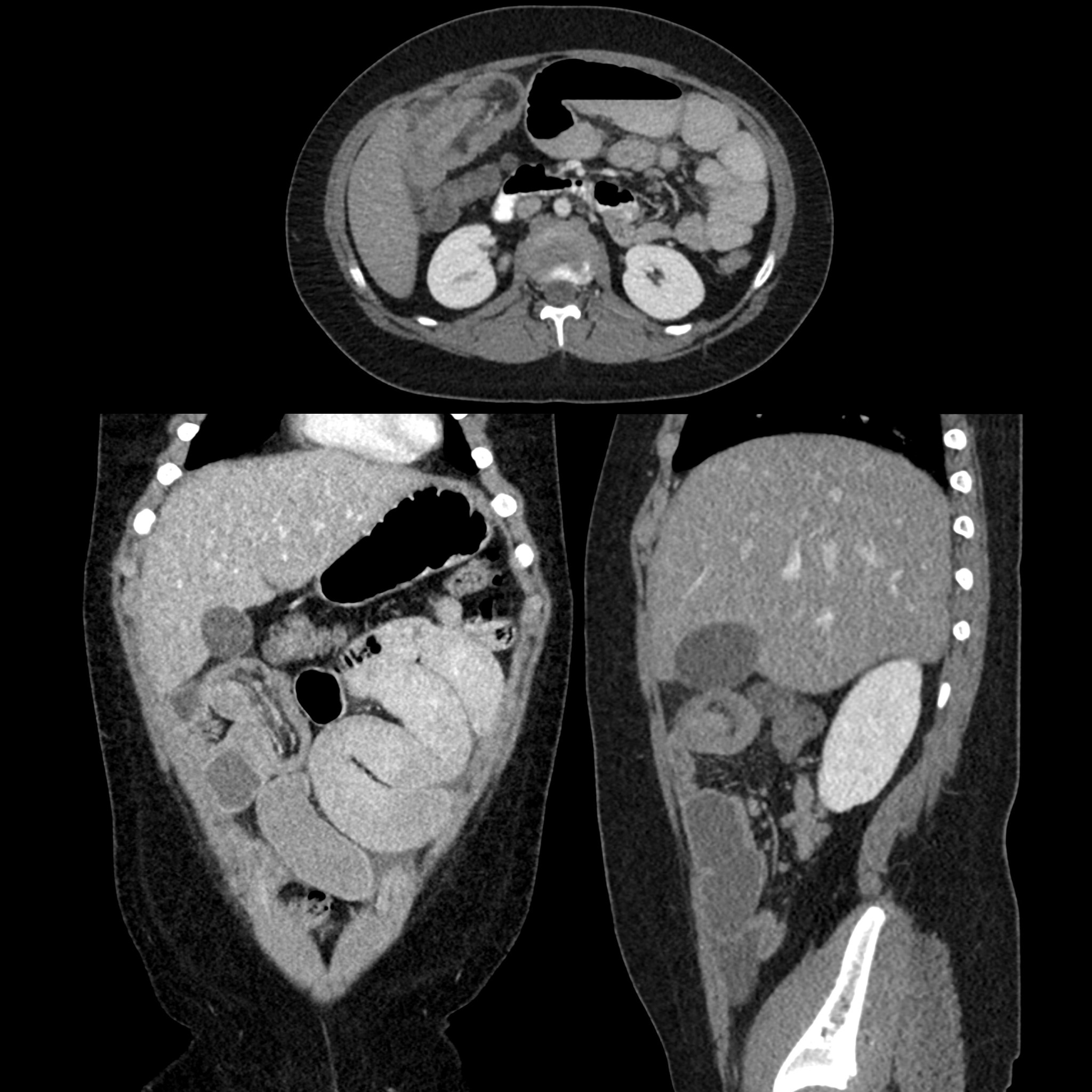 Pediatric Small Bowel-Small Bowel Intussusception | Pediatric Radiology ...