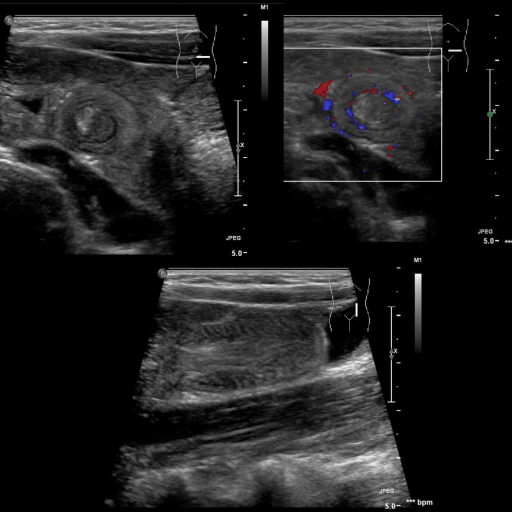 Pediatric Small Bowel-Small Bowel Intussusception | Pediatric Radiology ...