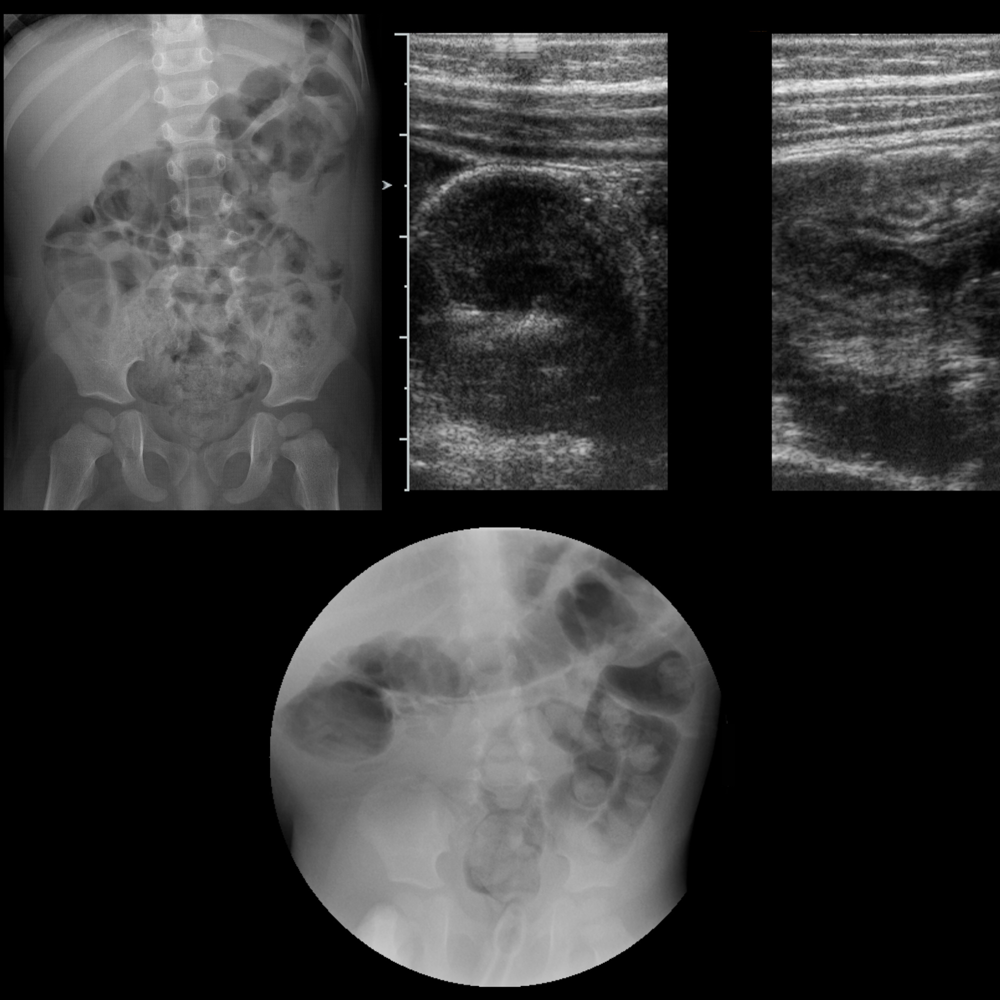 Ileocolic Intussusception | Pediatric Radiology Reference Article ...