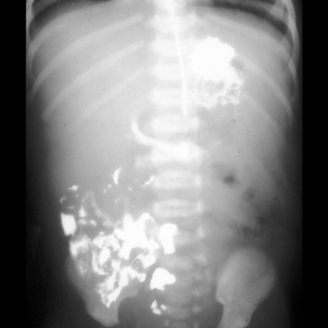 Newborn with non-bilious vomiting | Pediatric Radiology Case ...