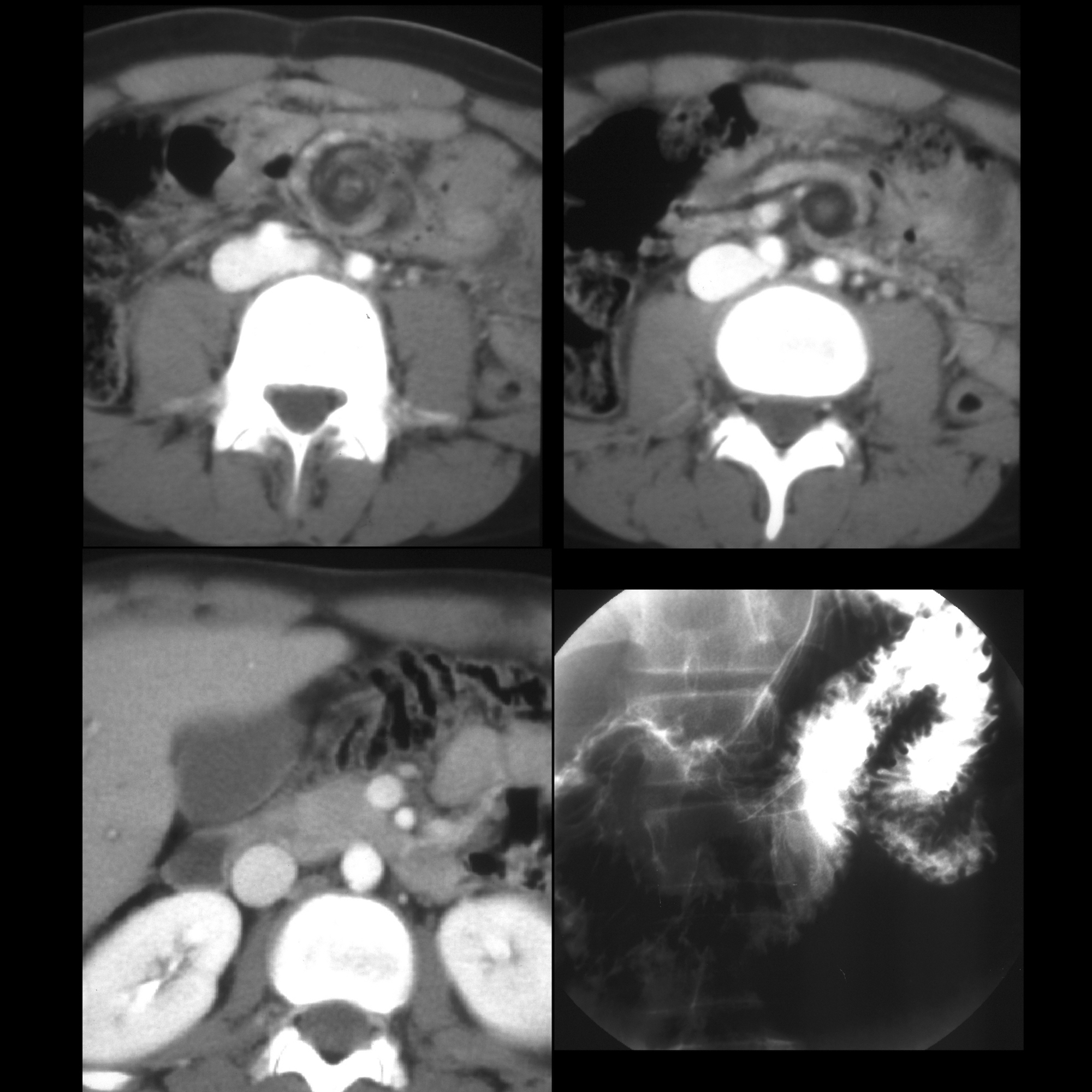 Pediatric Small Bowel Volvulus | Pediatric Radiology Reference Article ...