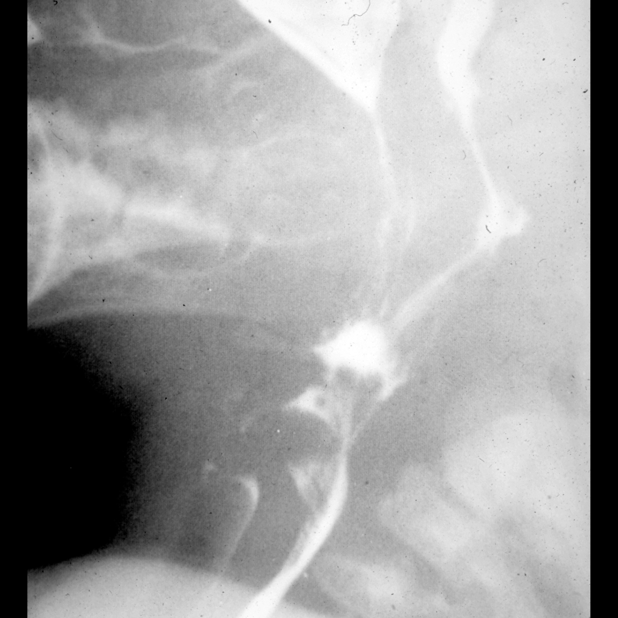 Pediatric Aspiration | Pediatric Radiology Reference Article ...