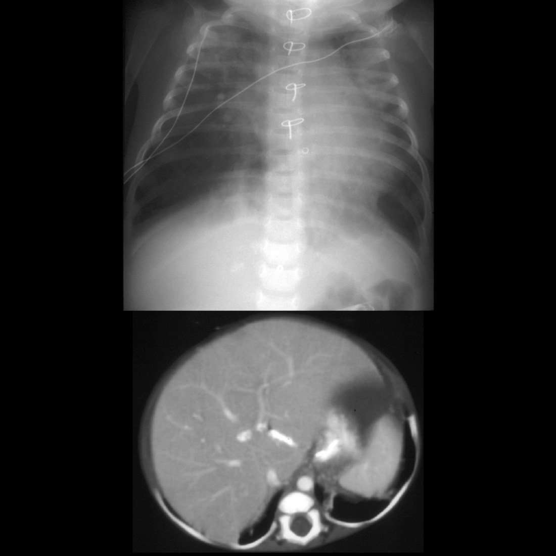 Umbilical Venous Catheter Malfunction / Malposition / Misposition ...