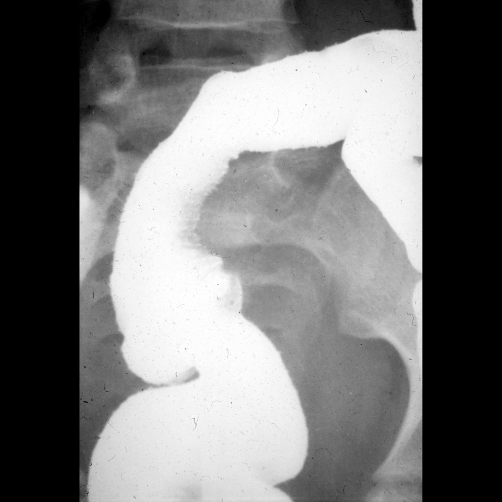 Pediatric Ulcerative Colitis | Pediatric Radiology Reference Article ...