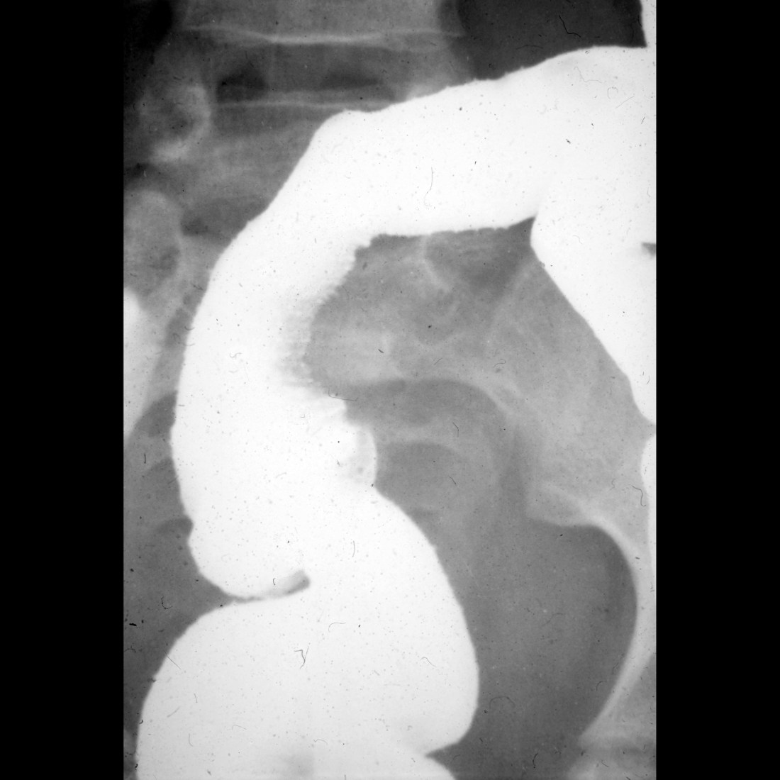Pediatric Ulcerative Colitis | Pediatric Radiology Reference Article ...