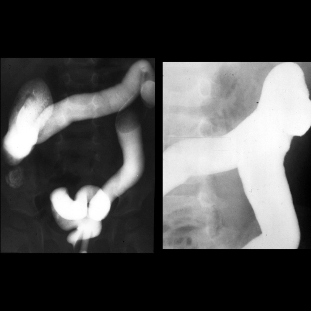 Pediatric Ulcerative Colitis | Pediatric Radiology Reference Article ...