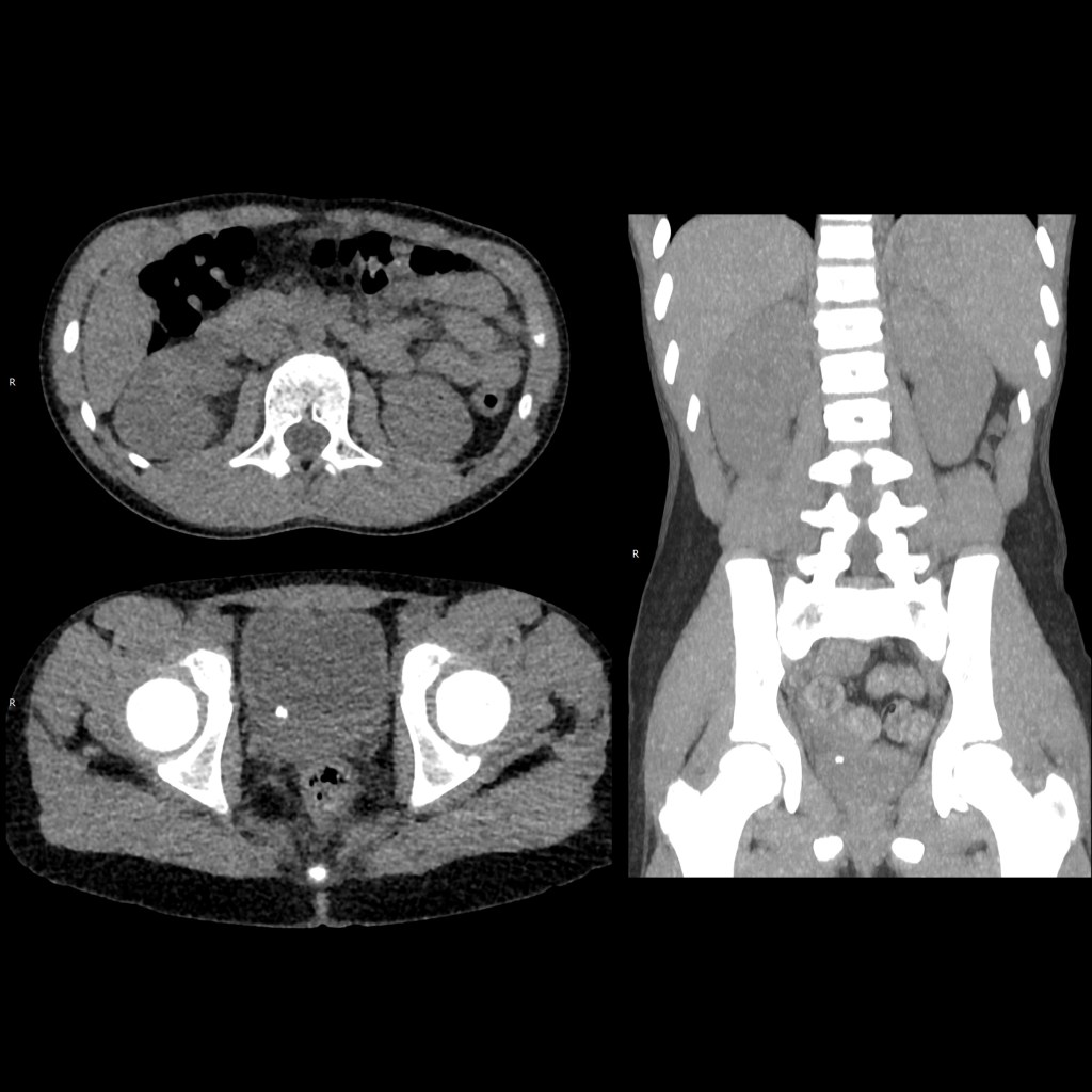 X Ray Or Ct Scan For Kidney Stone Urolithiasis | Radiology Reference