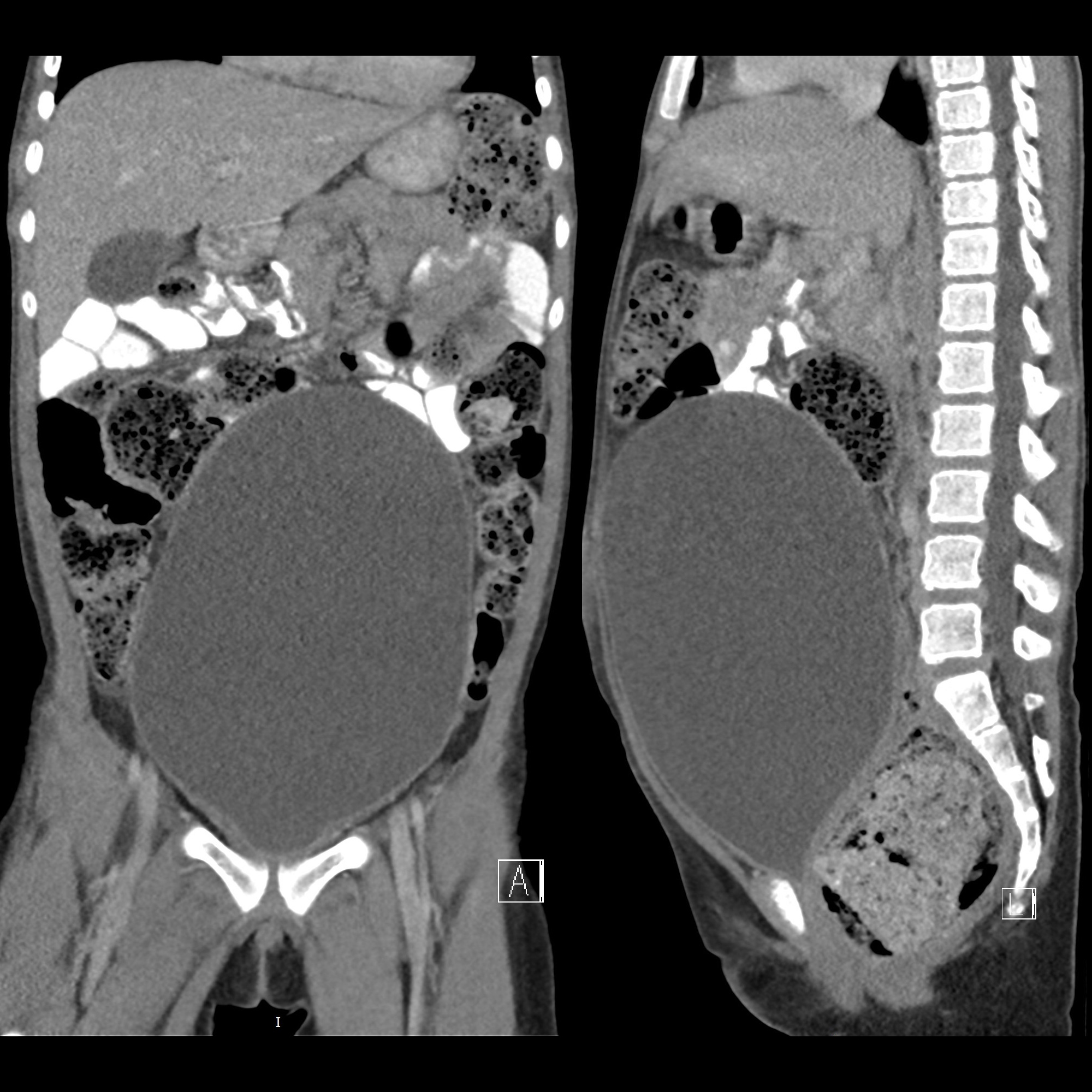 Pediatric Constipation | Pediatric Radiology Reference Article ...